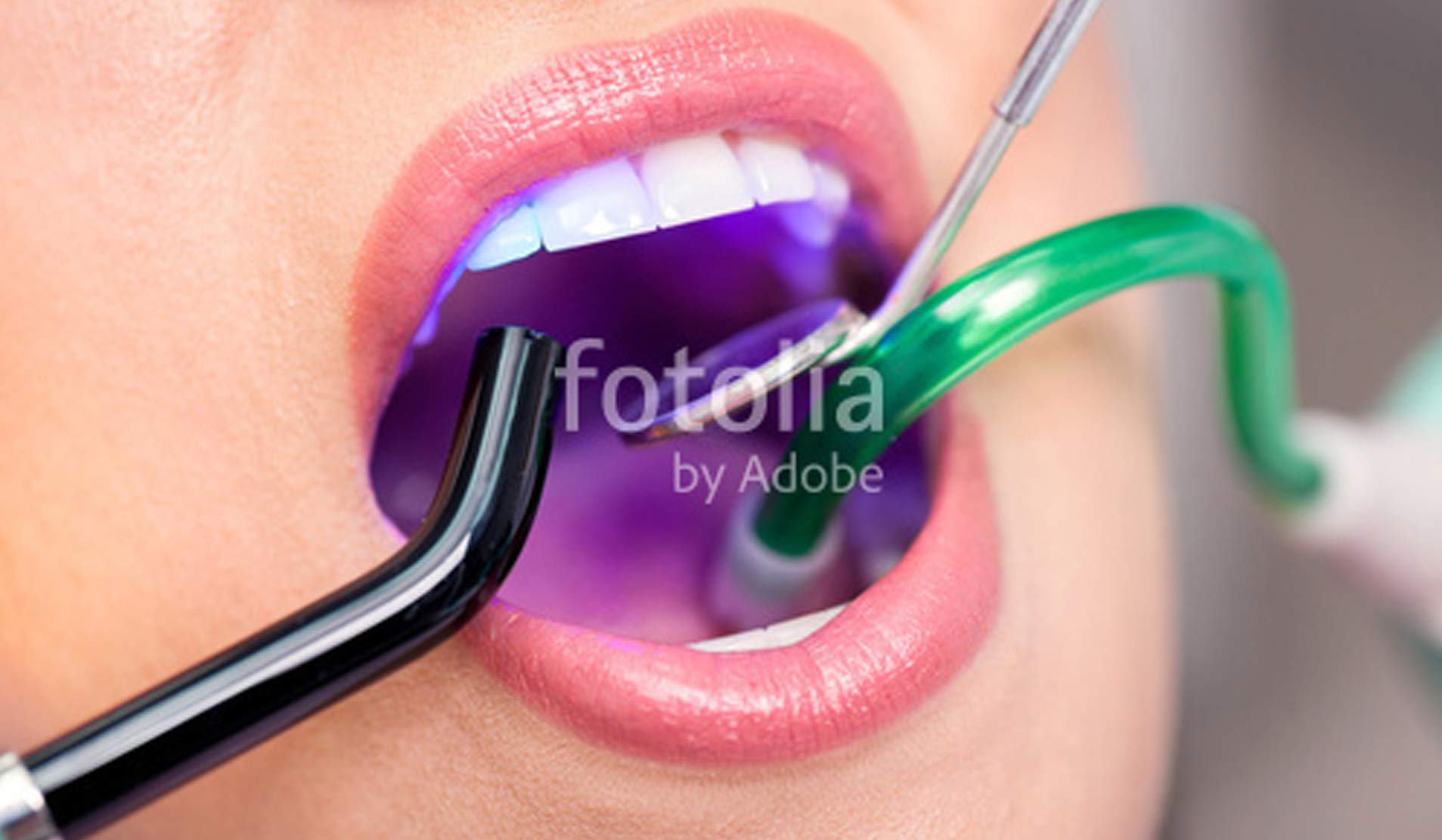 laser-bleaching – Zahnarzt in Prien am Chiemsee bei Rosenheim & Traunstein